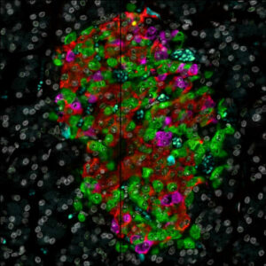 Screening for type 1 diabetes | Breakthrough T1D UK