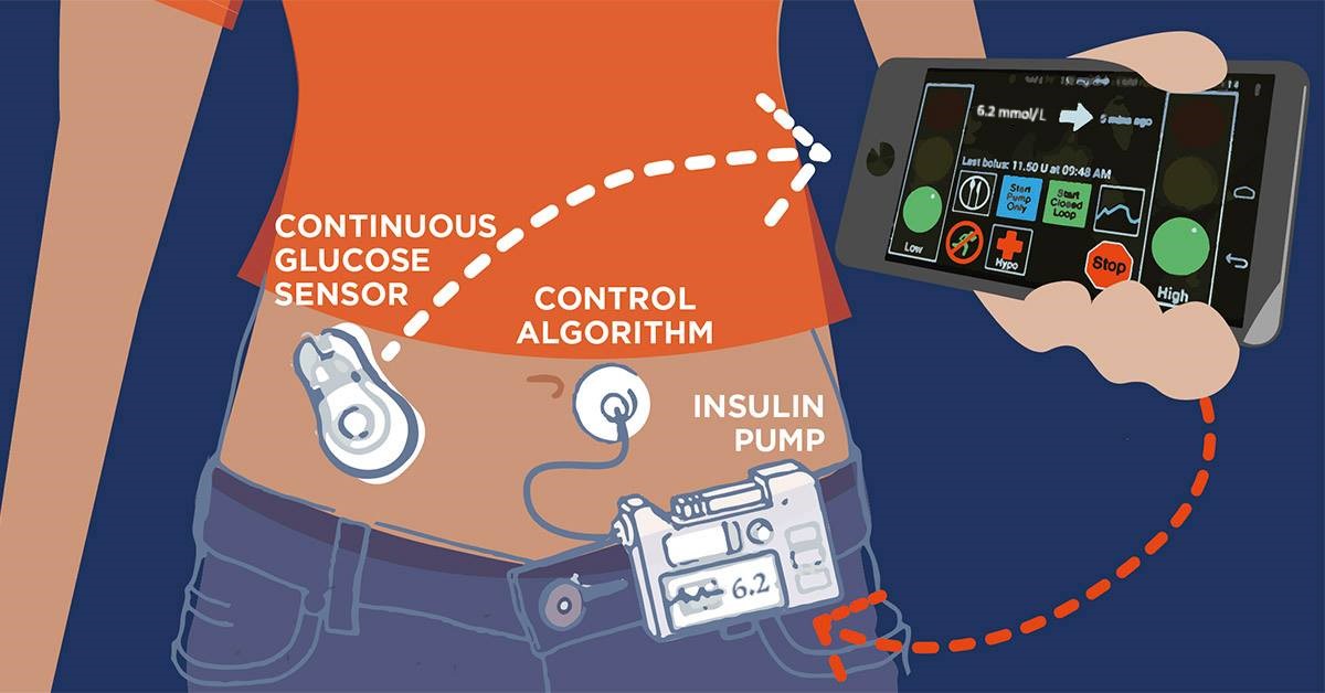 Dexcom launches G7 continuous glucose monitor | Breakthrough T1D UK