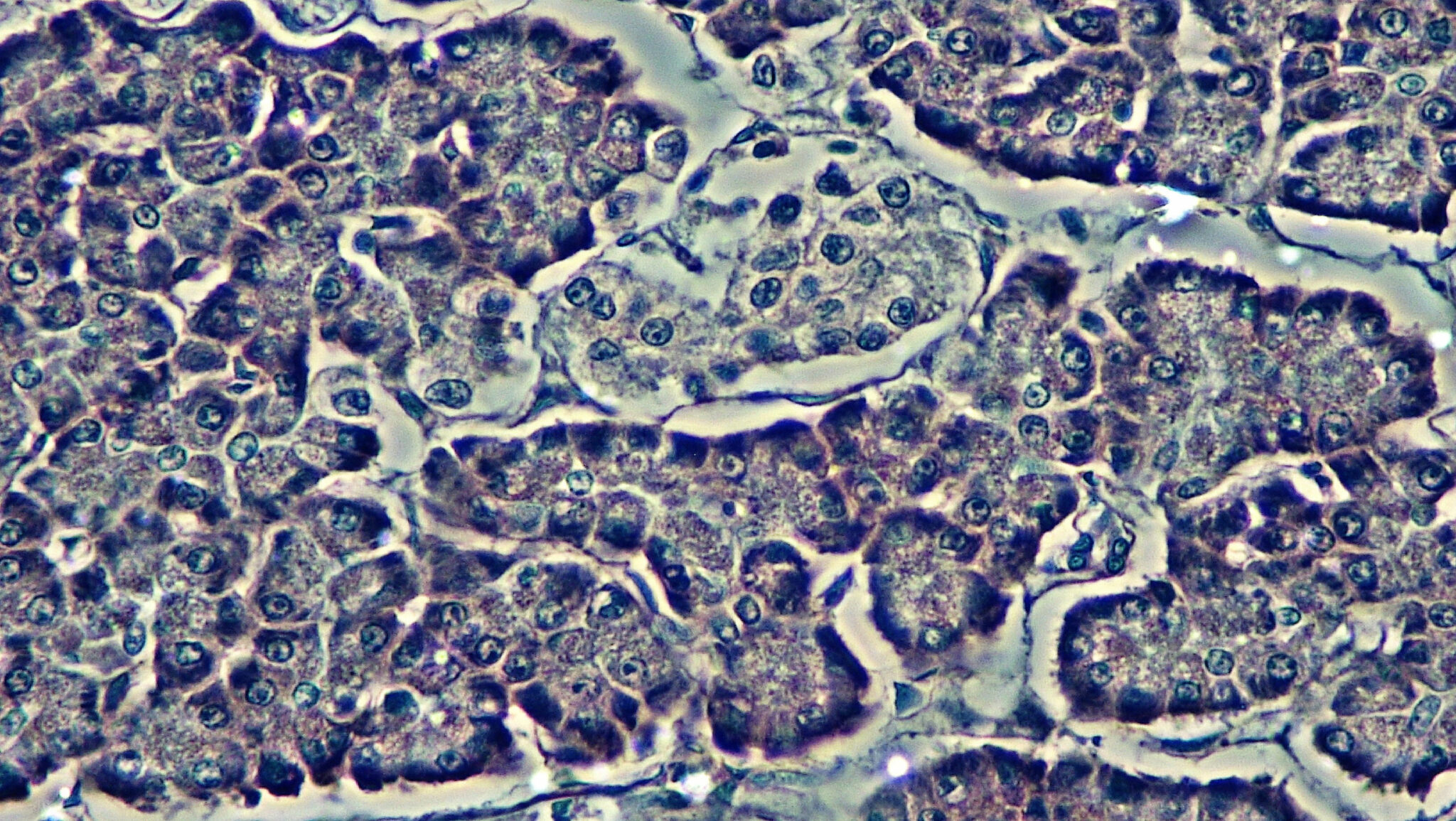 Islet transplants | Breakthrough T1D UK